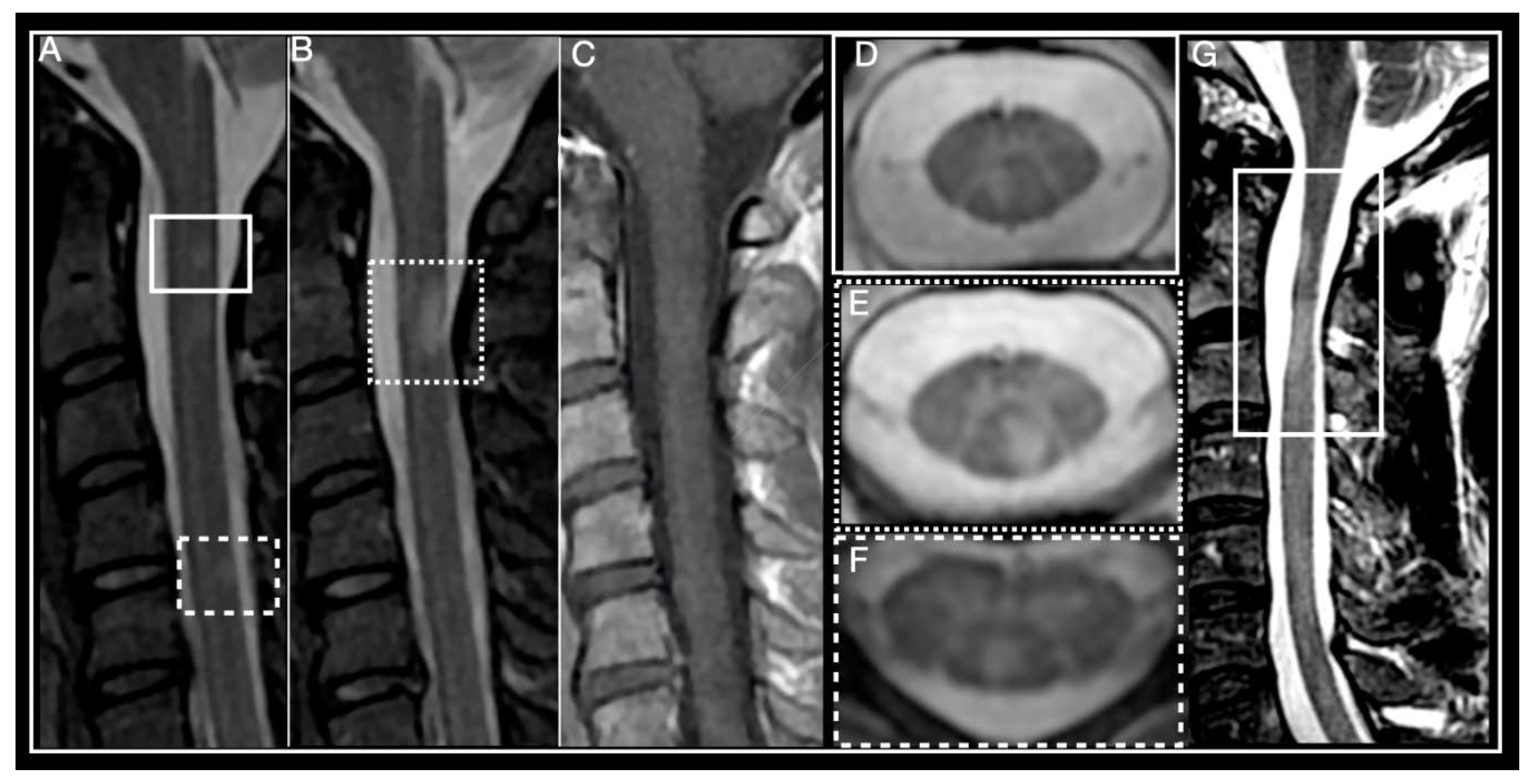 Cervical Spine Mri Ms Cervical Spine Mri Ms