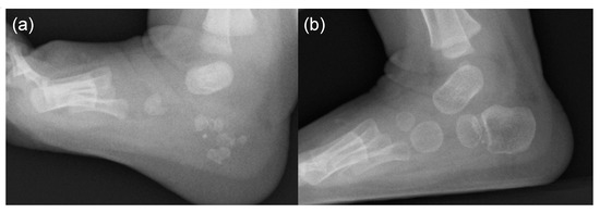 Biomedicines | Special Issue : Fibrodysplasia Ossificans Progressiva ...