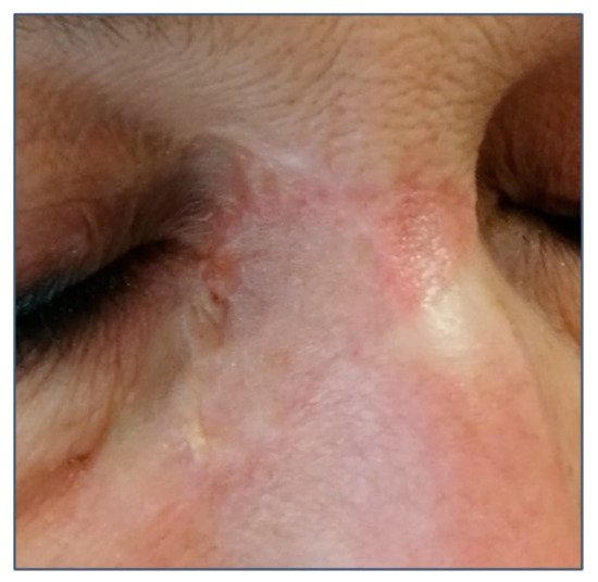 Basal Cell Carcinoma: From Pathophysiology to Novel Therapeutic Approaches