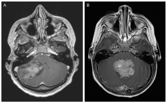 Typical Pediatric Brain Tumors Occurring in Adults—Differences in ...
