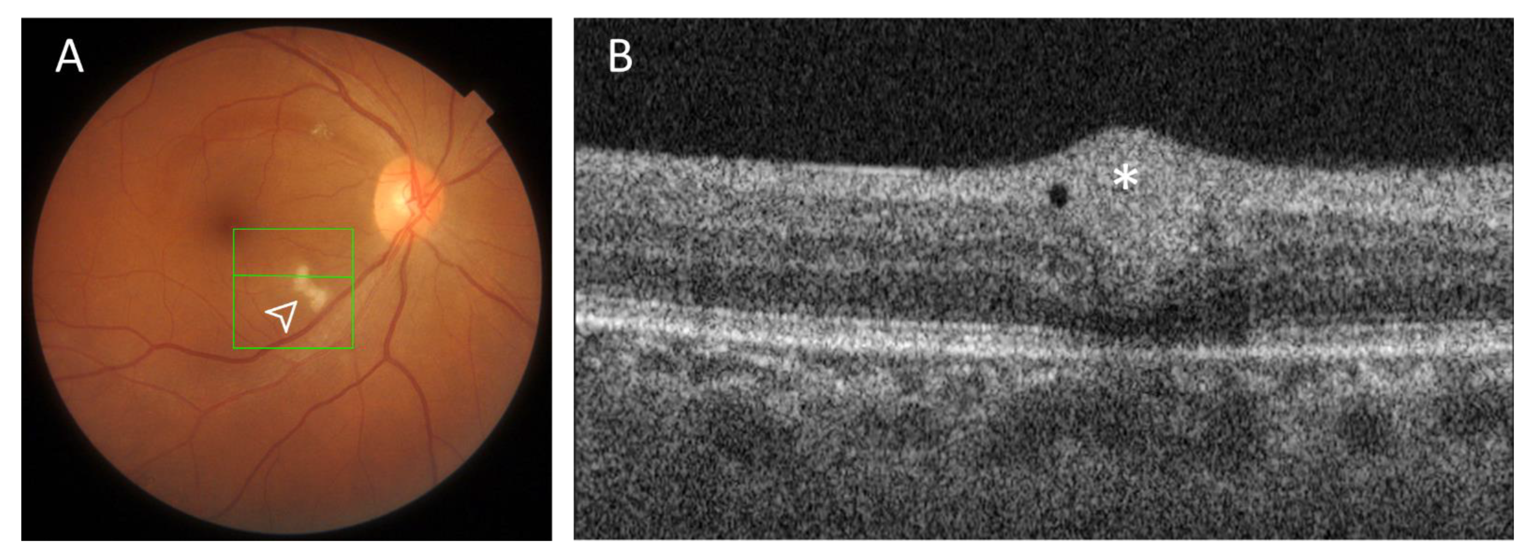 Cotton Wool Spot Oct