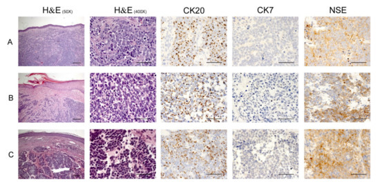 Merkel Cell Carcinoma