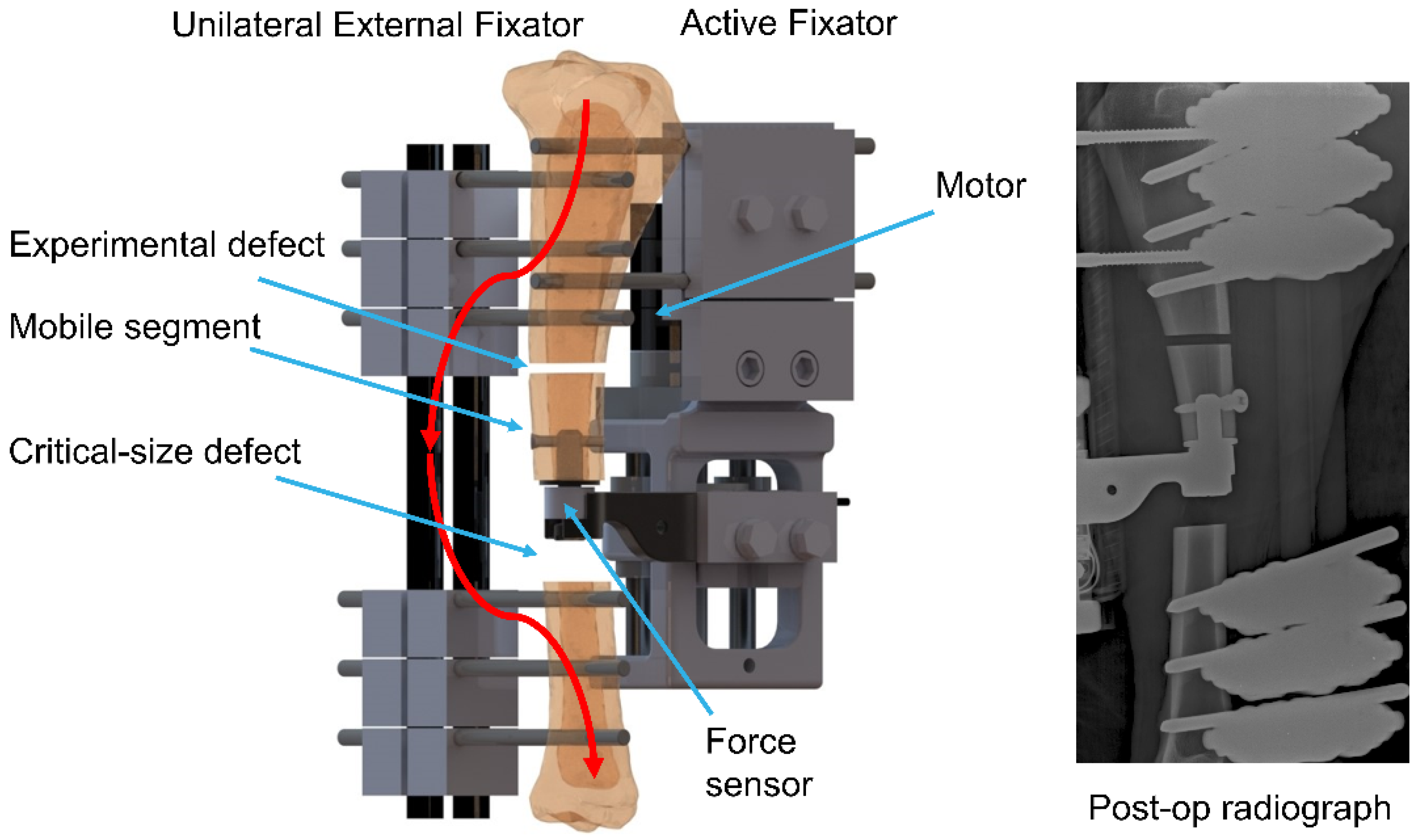 Short-Term Bone Healing Response to Mechanical Stimulation—A Case ...