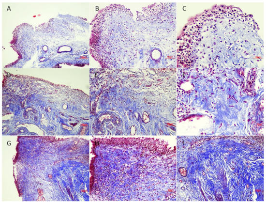 Possible Association between Bladder Wall Morphological Changes on ...