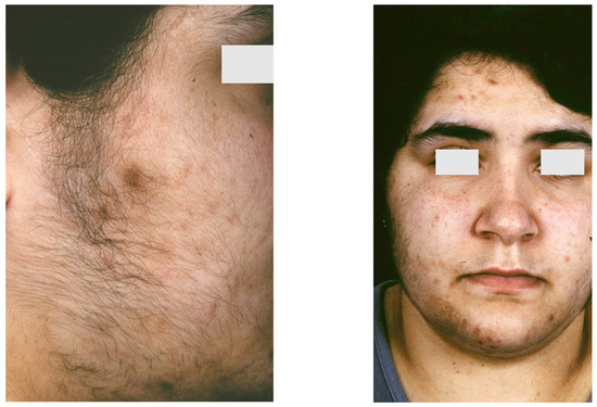Acne Syndromes and Mosaicism