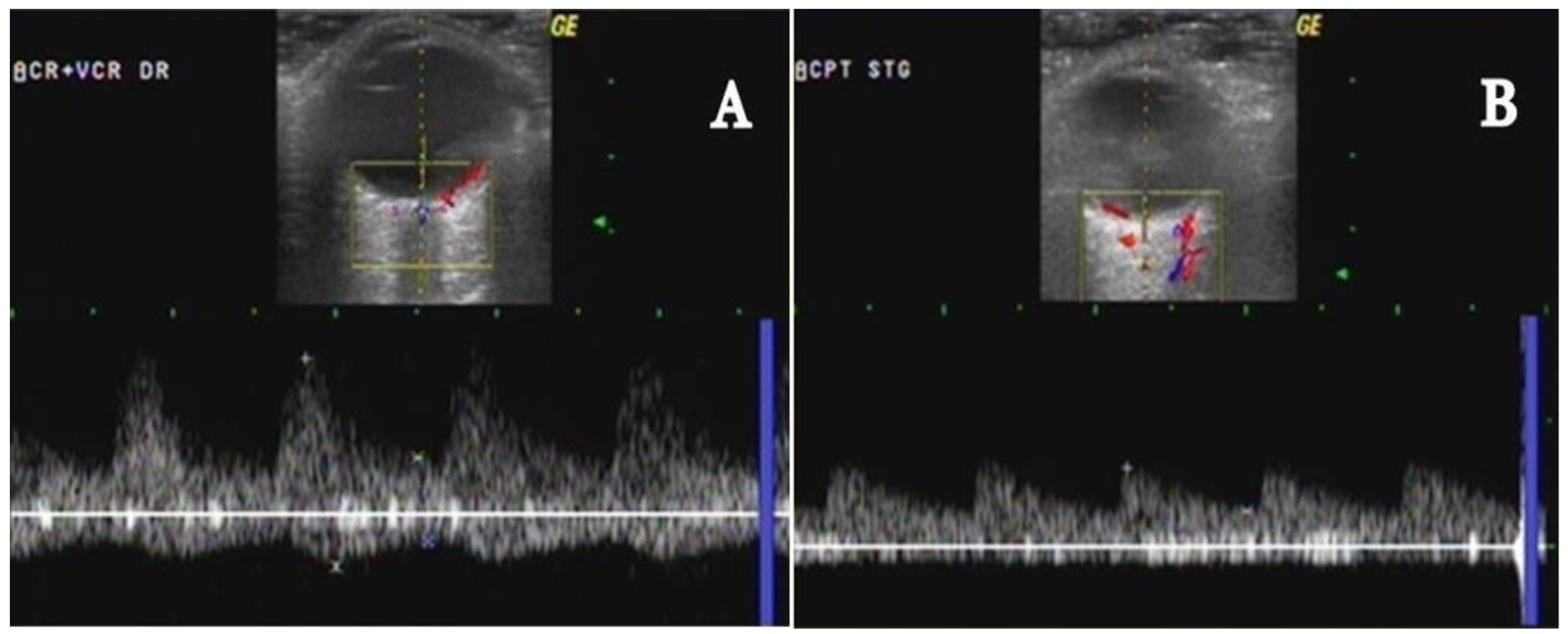 Temporal Artery Ultrasound