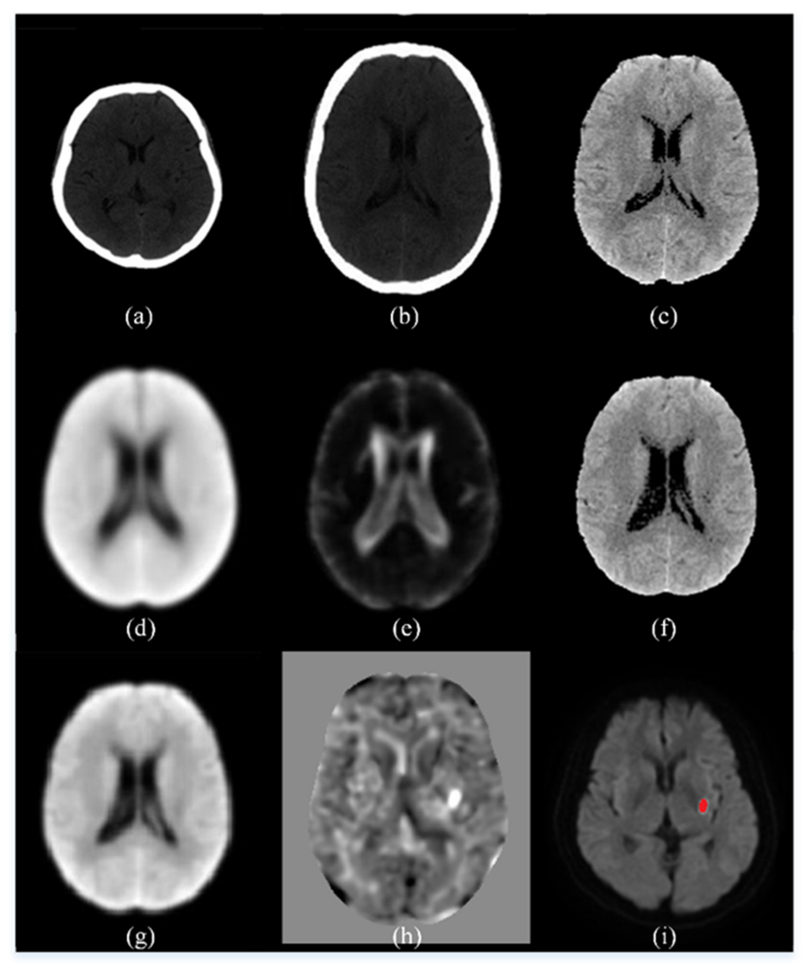 Automated Cerebral Infarct Detection on Computed Tomography Images ...