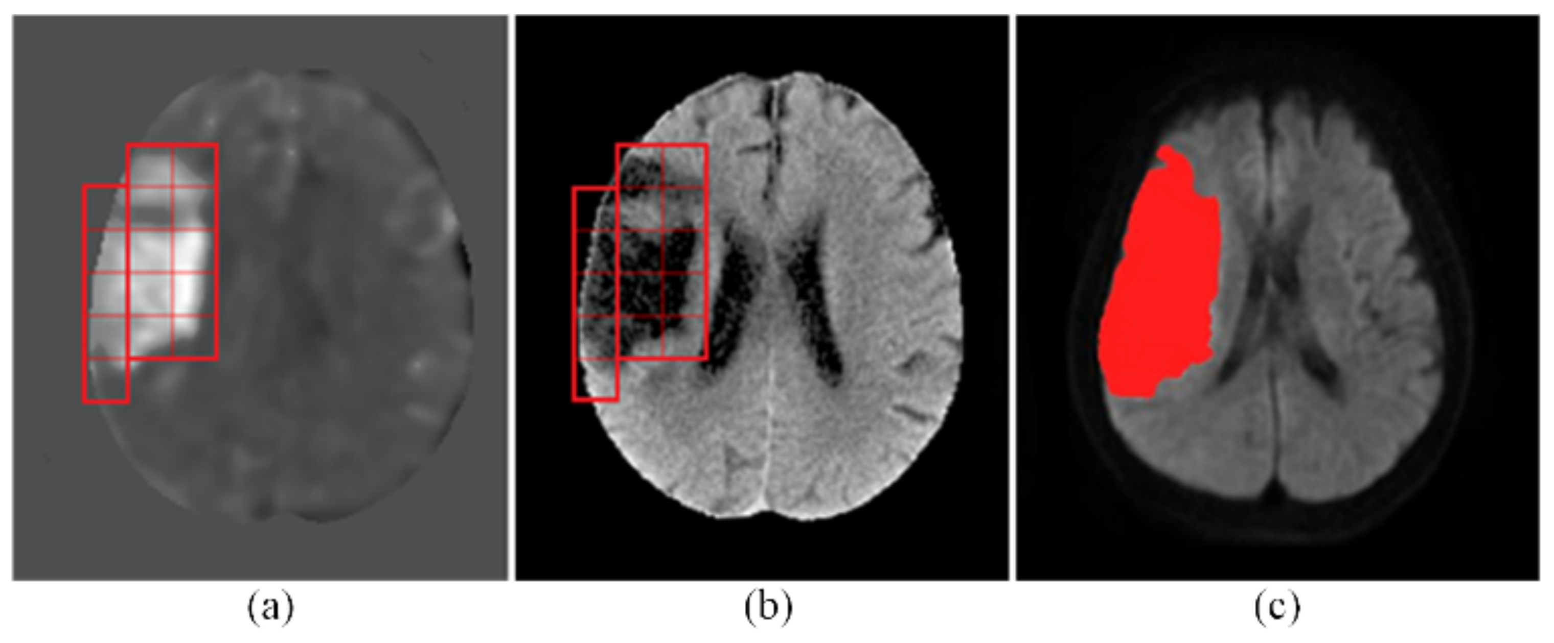 Automated Cerebral Infarct Detection on Computed Tomography Images ...