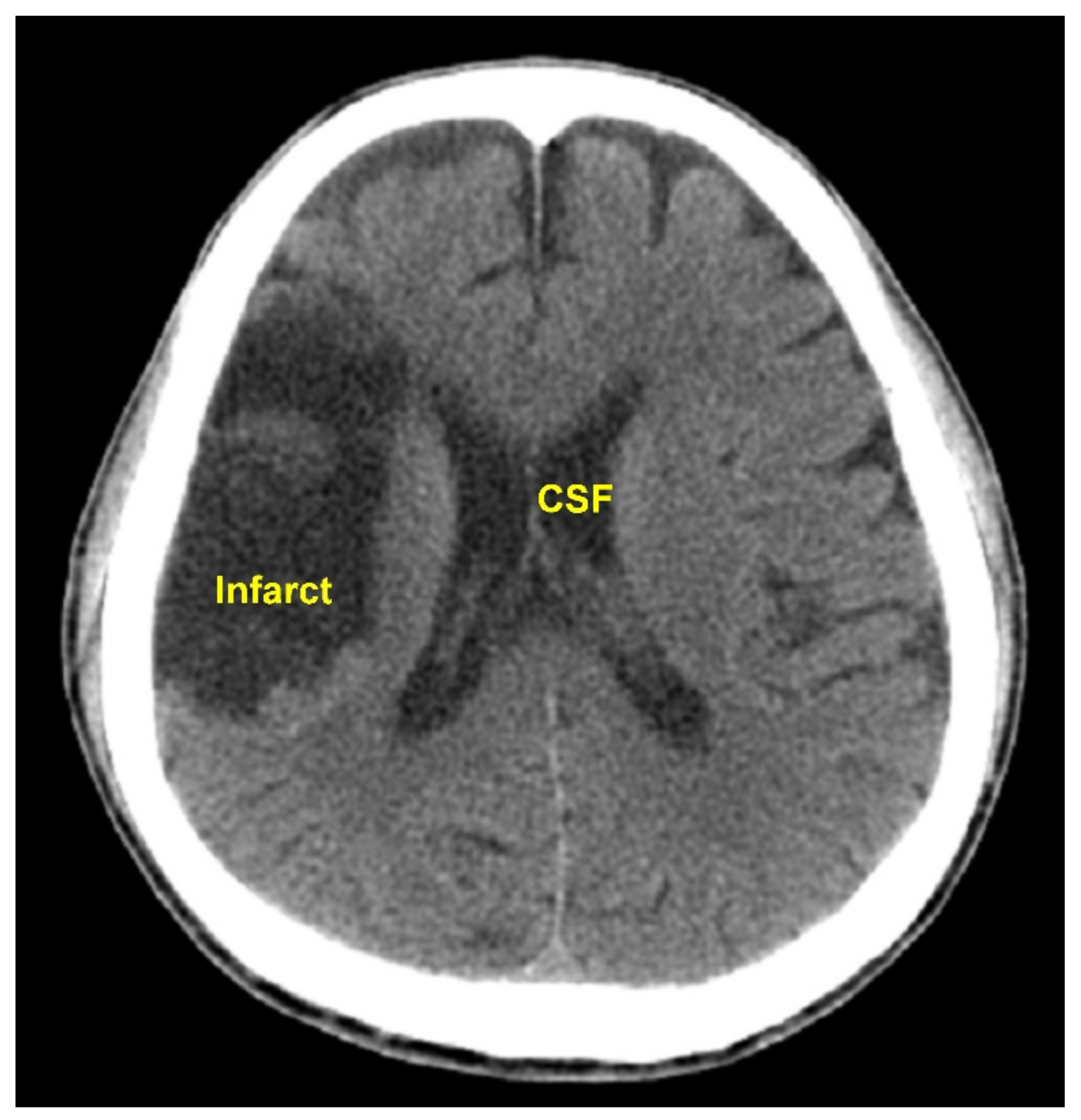 Automated Cerebral Infarct Detection on Computed Tomography Images ...