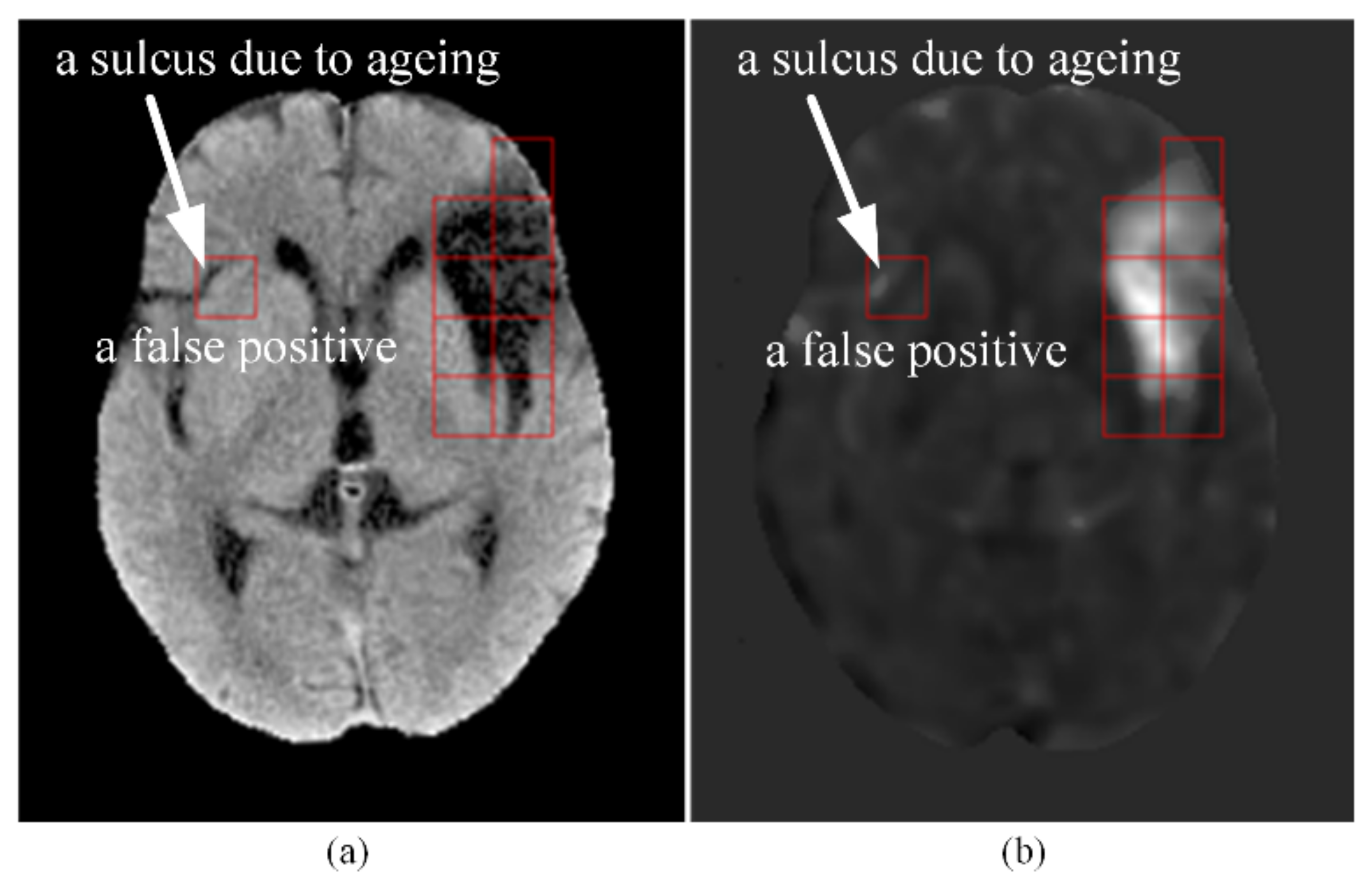 Automated Cerebral Infarct Detection on Computed Tomography Images ...