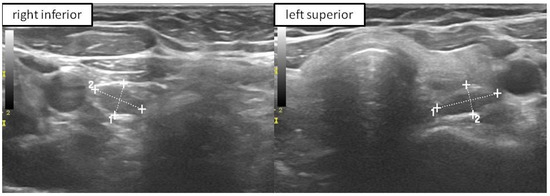 The Current Role of Parathyroid Fine-Needle Biopsy (P-FNAB) with iPTH ...