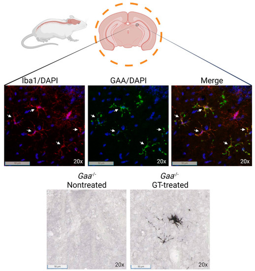 Gene Therapy Developments for Pompe Disease