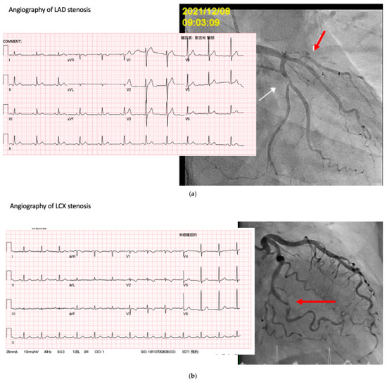 An Artificial Intelligence-Enabled ECG Algorithm for the Prediction and ...