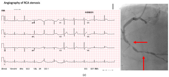 An Artificial Intelligence-Enabled ECG Algorithm for the Prediction and Localization of ...