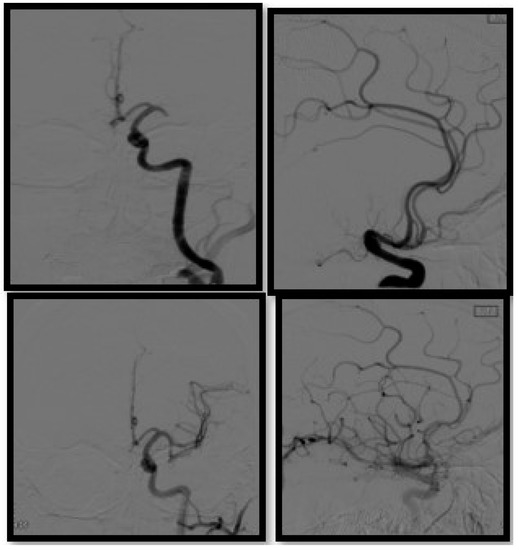 Endovascular Intervention in Acute Ischemic Stroke: History and Evolution