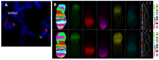 Clinical Manifestations of Various Molecular Cytogenetic Variants of ...