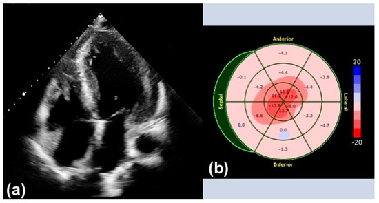 Advanced Imaging in Cardiac Amyloidosis