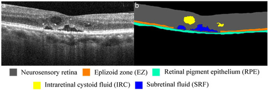 Automatic Segmentation of Retinal Fluid and Photoreceptor Layer from Optical Coherence ...