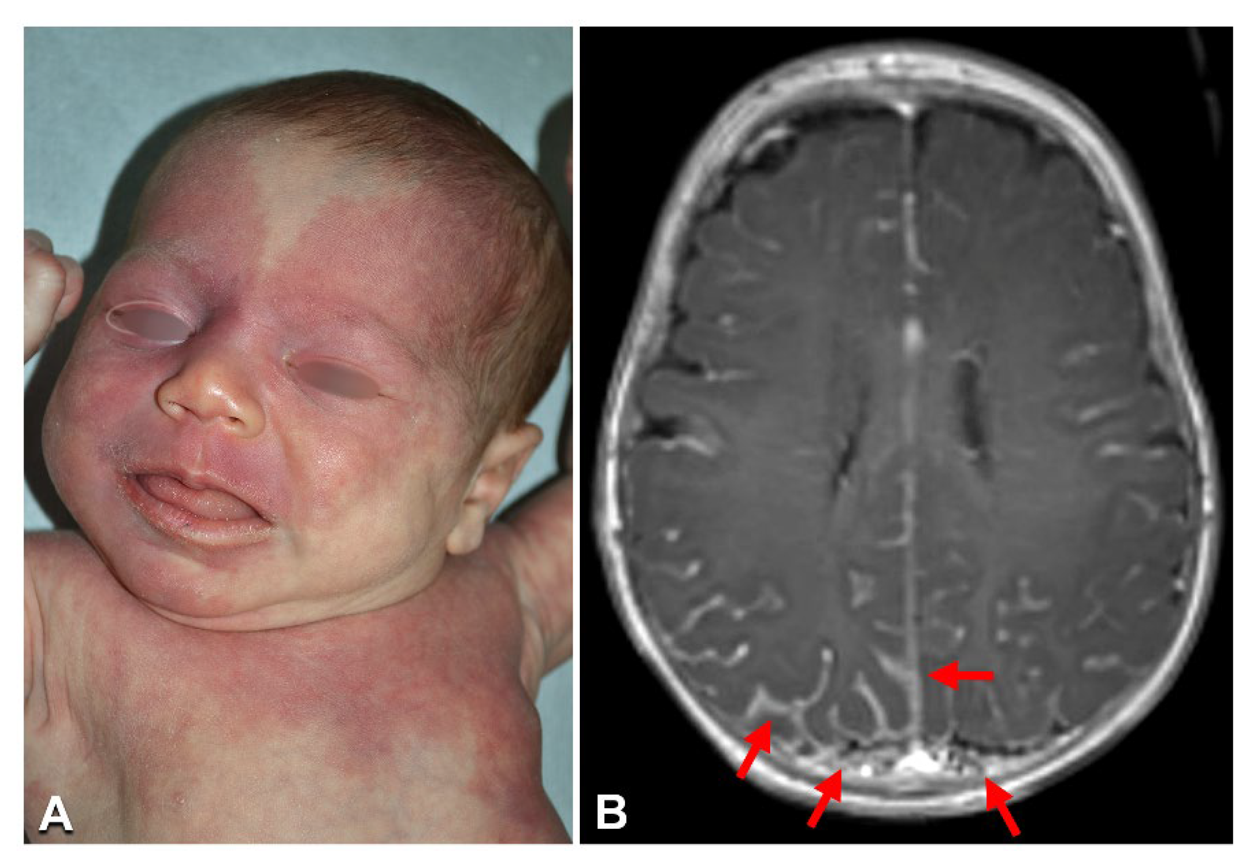 Clinical and Molecular Spectrum of Sporadic Vascular Malformations: A ...