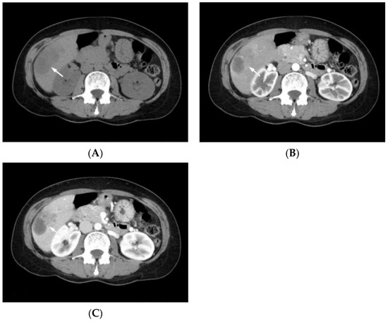 Combined Hepatocellular-Cholangiocarcinoma: An Update on Pathology and Diagnostic Approach