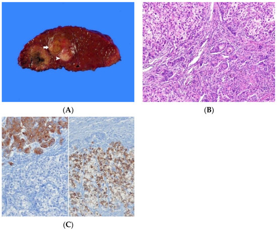 Combined Hepatocellular-Cholangiocarcinoma: An Update on Pathology and Diagnostic Approach