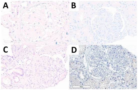 DNAJB9 Is a Reliable Immunohistochemical Marker of Fibrillary ...
