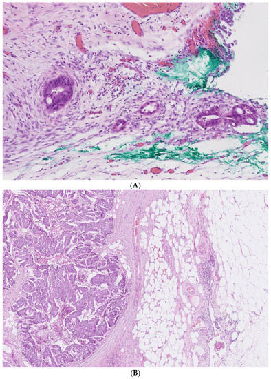 Biomedicines | Free Full-Text | miR-200b, ZEB2 and PTPN13 Are ...