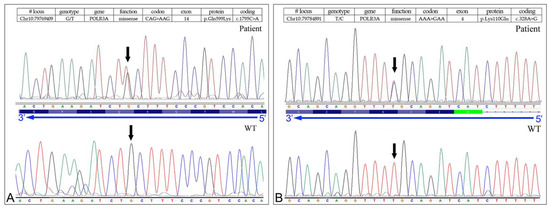 Identification of a Novel Missense Mutation of POLR3A Gene in a Cohort of Sicilian Patients with ...