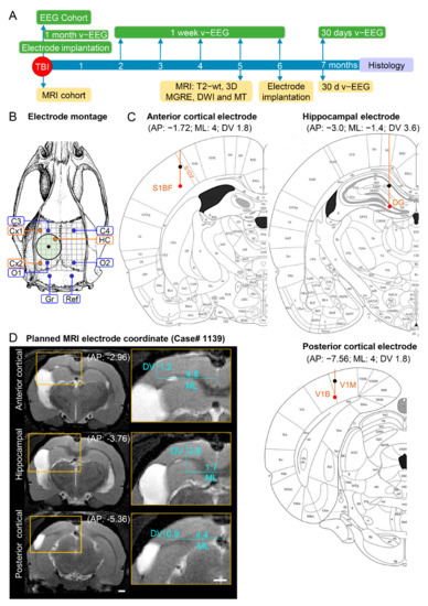 MRI-Guided Electrode Implantation for Chronic Intracerebral Recordings ...