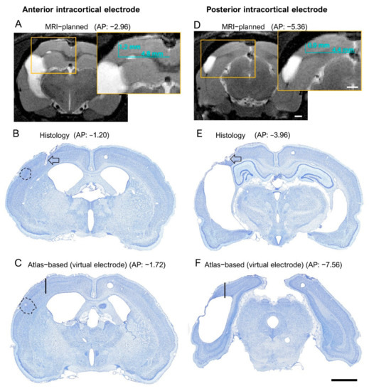 MRI-Guided Electrode Implantation for Chronic Intracerebral Recordings ...