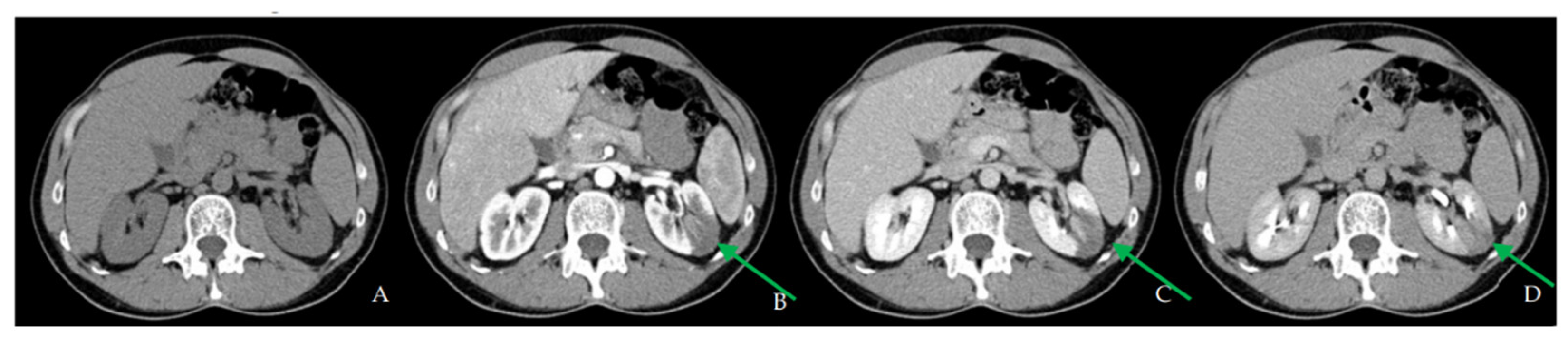 Arterial Thrombotic Complications in COVID-19: A Case of Renal Infarction