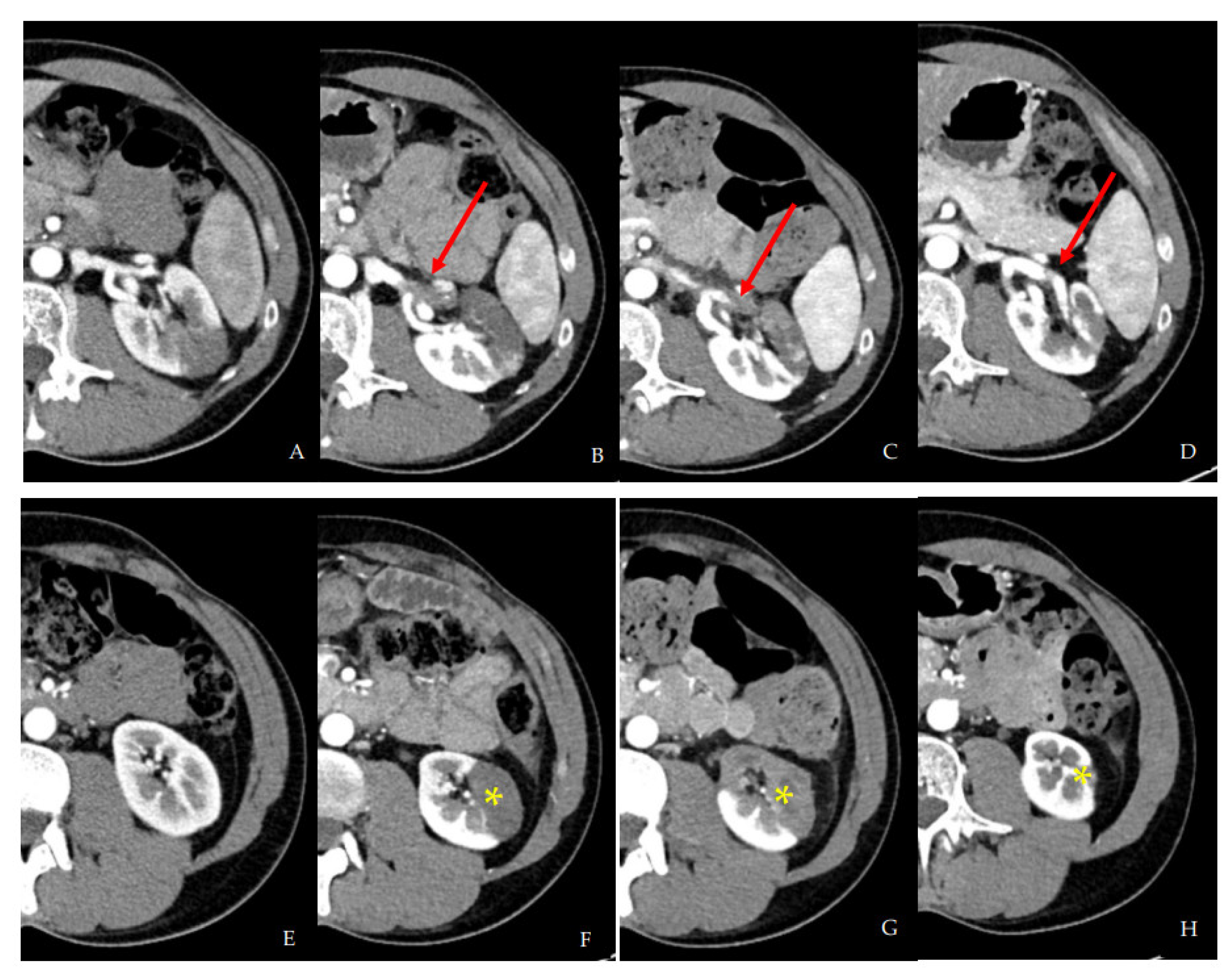 Arterial Thrombotic Complications in COVID-19: A Case of Renal Infarction