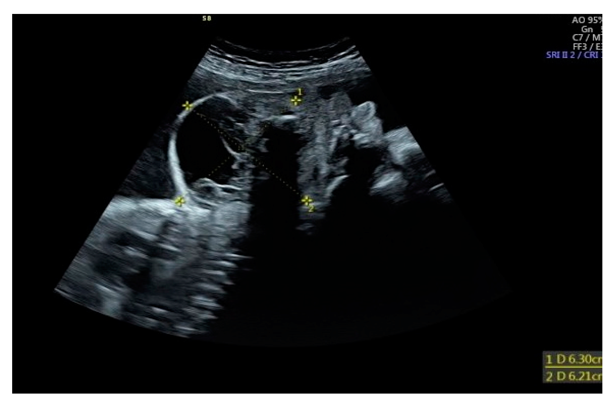 Multispecialty Approach to a Very Large Congenital Head and Neck Cystic ...