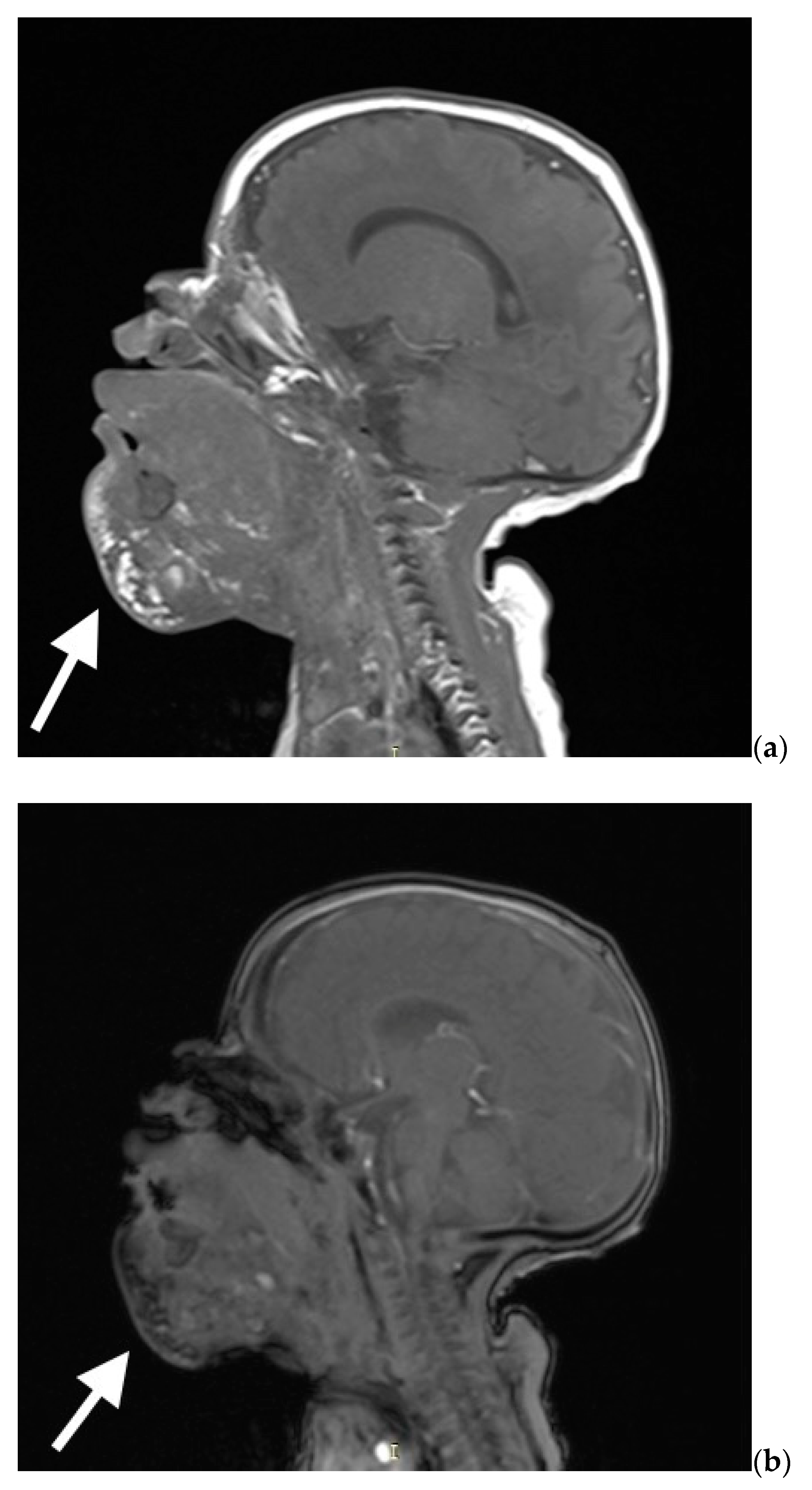Multispecialty Approach to a Very Large Congenital Head and Neck Cystic ...