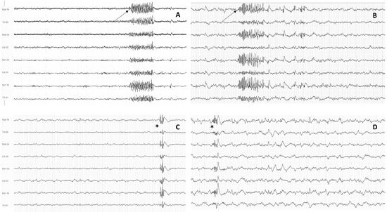 Generalized Seizures Eeg