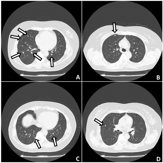 Benign Metastasizing Leiomyoma of the Lung: Diagnostic Process and ...