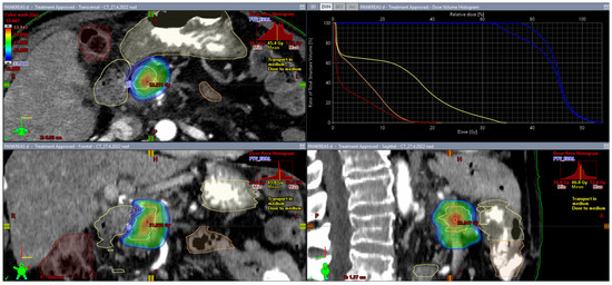 Stereotactic Body Radiotherapy (SBRT) of Pancreatic Cancer—A Critical ...