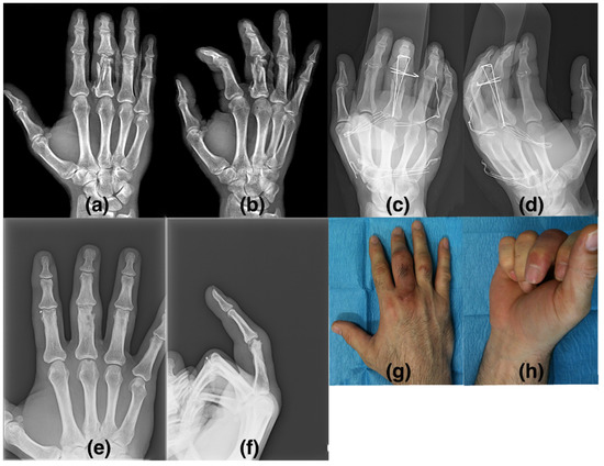 Biophysical Stimulation in Delayed Fracture Healing of Hand Phalanx: A ...
