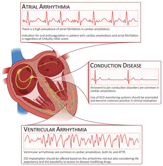 Arrhythmic Burden in Cardiac Amyloidosis: What We Know and What We Do Not