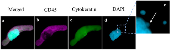 Micronuclei in Circulating Tumor Associated Macrophages Predicts ...
