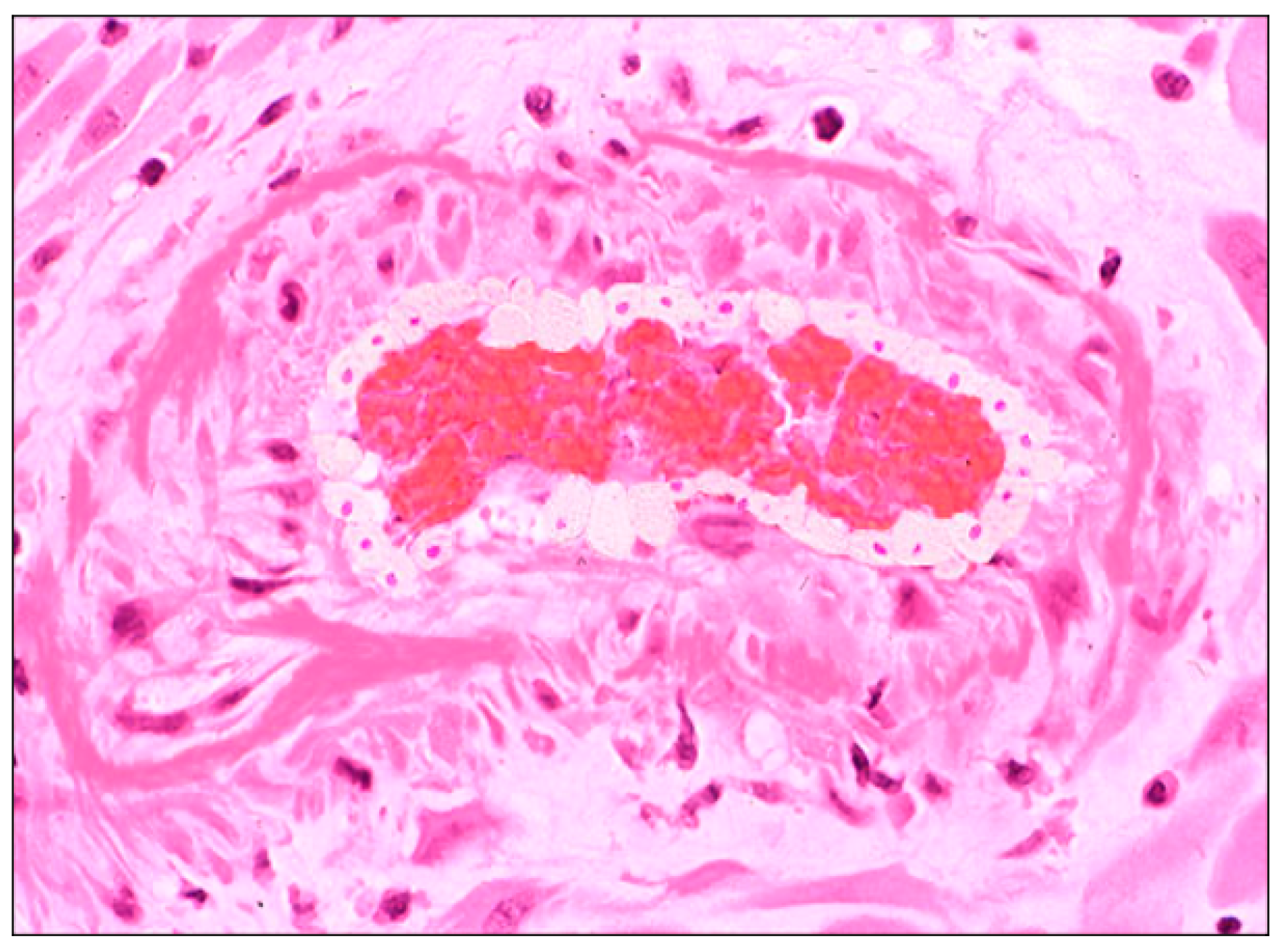 Characteristics of Placental Histopathology in Women with Uncomplicated ...