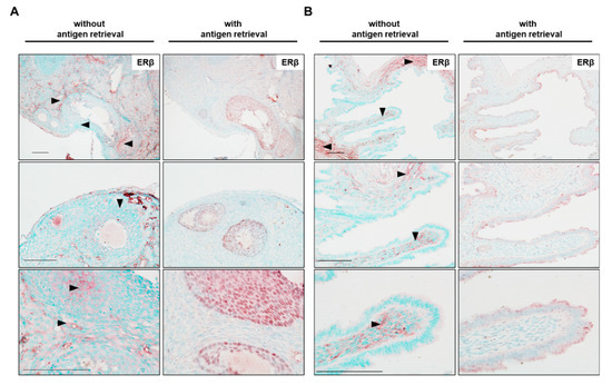 Immunohistochemical Detection of Estrogen Receptor-Beta (ERβ) with ...