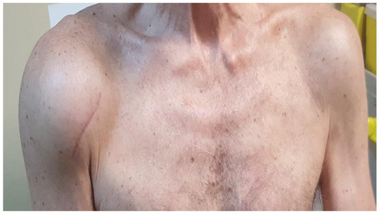 Biomedicines | Free Full-Text | Transthyretin Cardiac Amyloidosis: A ...