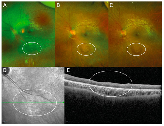Gene Therapy with Voretigene Neparvovec Improves Vision and Partially ...