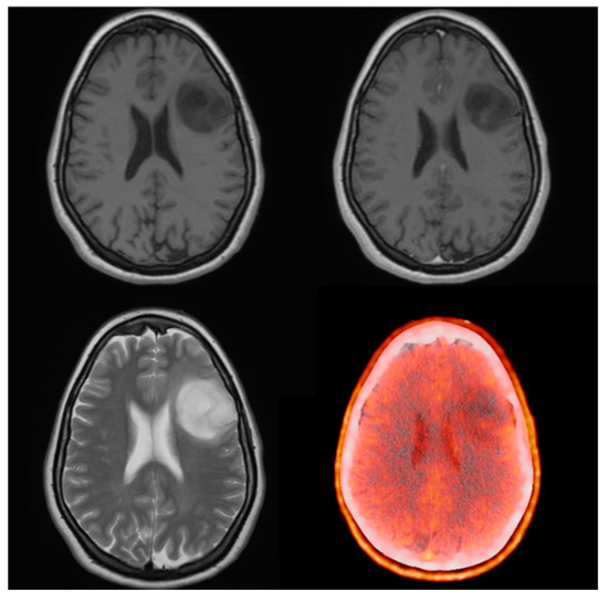 Therapy Defining at Initial Diagnosis of Primary Brain Tumor—The Role ...