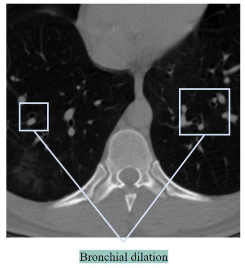 Automated Detection of Broncho-Arterial Pairs Using CT Scans Employing ...