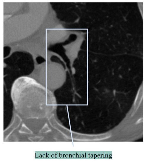 Automated Detection of Broncho-Arterial Pairs Using CT Scans Employing ...