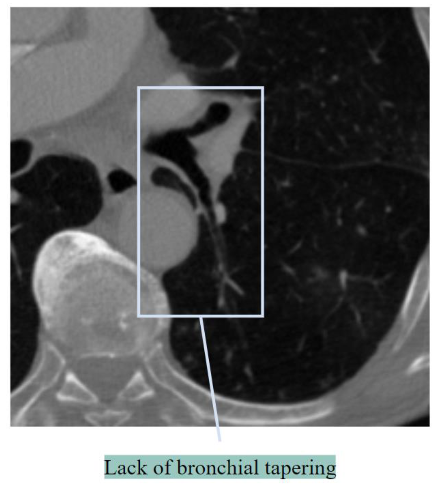 Automated Detection of Broncho-Arterial Pairs Using CT Scans Employing ...