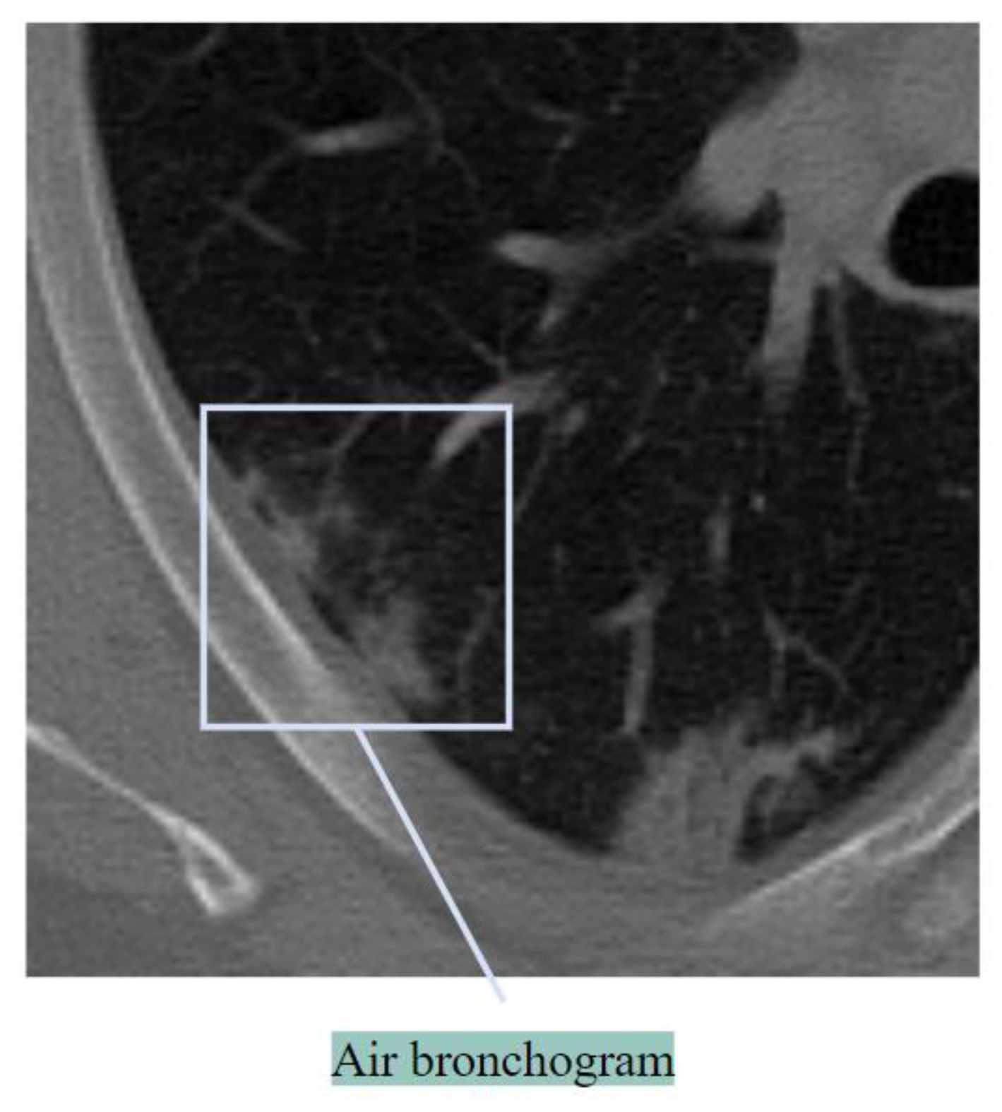 Biomedicines | Free Full-Text | Automated Detection of Broncho-Arterial ...