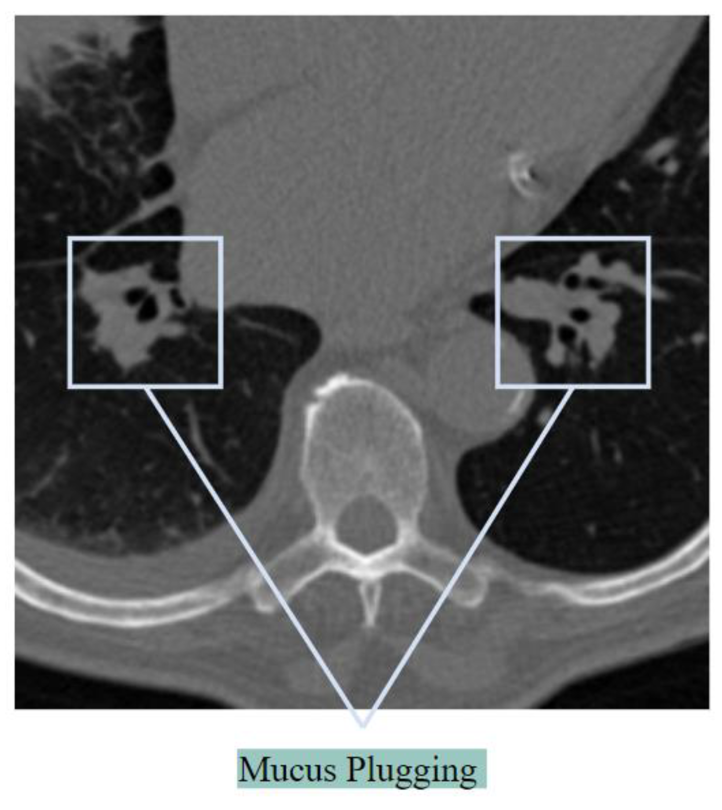 Automated Detection of Broncho-Arterial Pairs Using CT Scans Employing ...